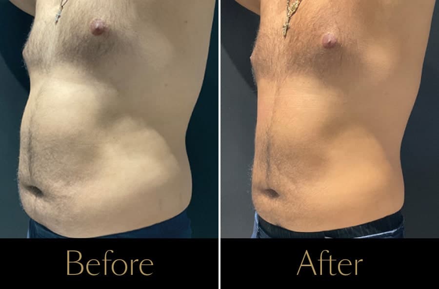Emerald Laser - Rakus Clinic